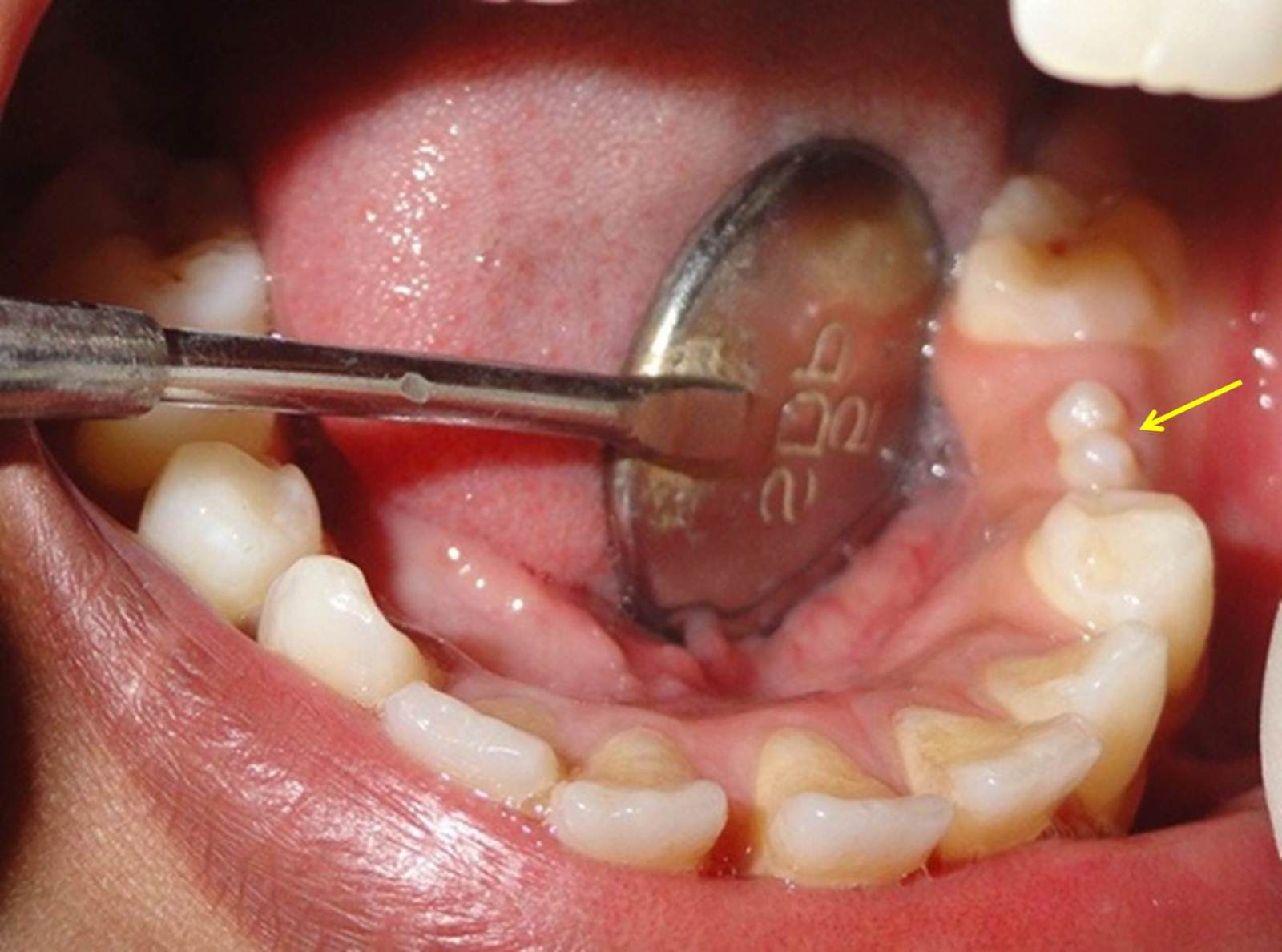 Permanent Mandibular Second Premolar with Unusual Morphology in ...
