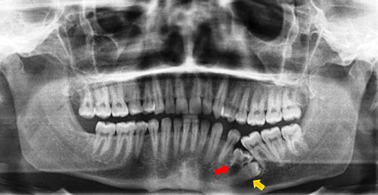 Impaction of Primary Second Molar and Permanent Second Premolar ...