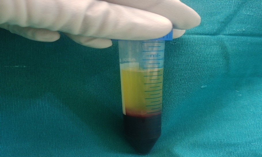 Role of Platelet Rich Fibrin Matrix (PRFM) in the Management of Non ...