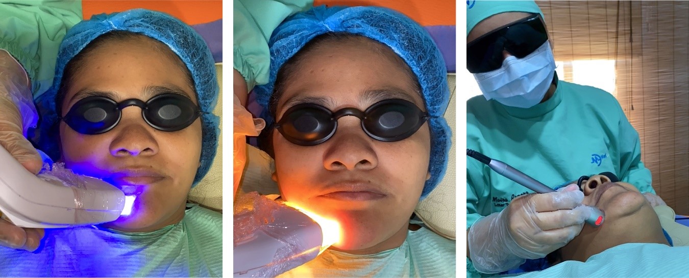 Diode Laser Assisted Facial Lifting: A New Technical and Case Report ...
