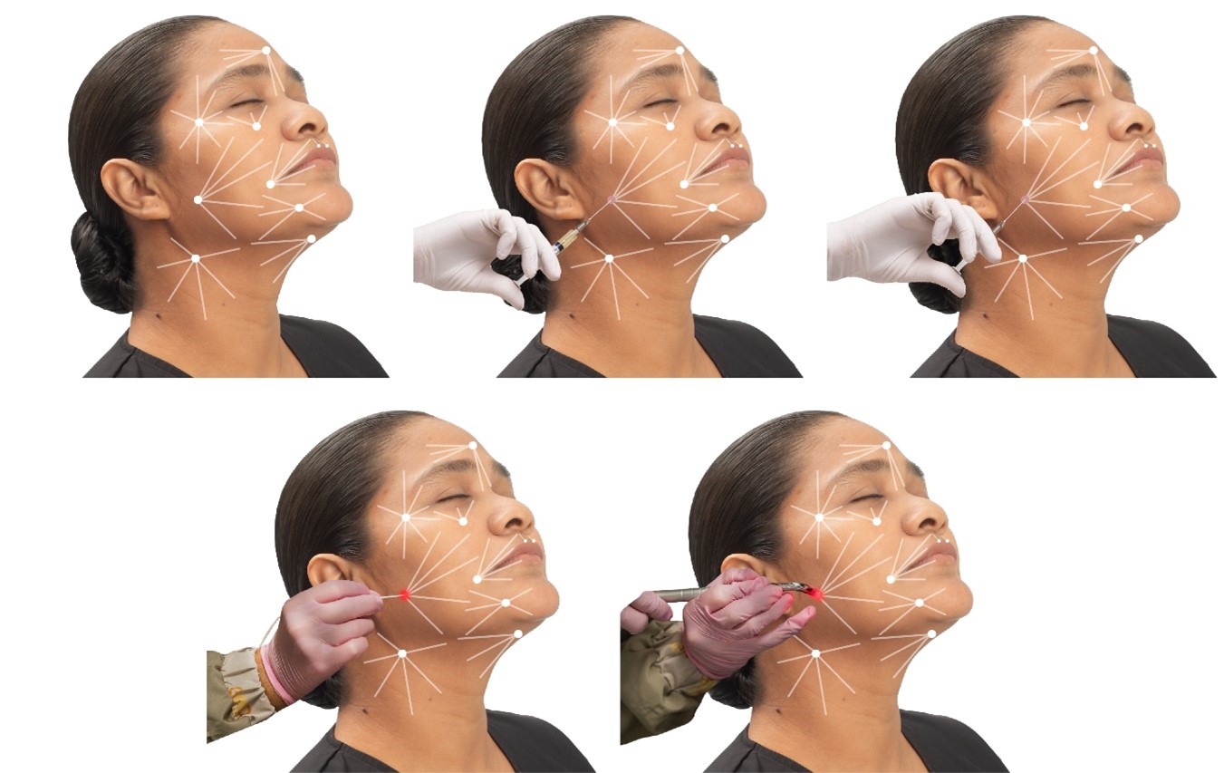 Diode Laser Assisted Facial Lifting: A New Technical and Case Report ...