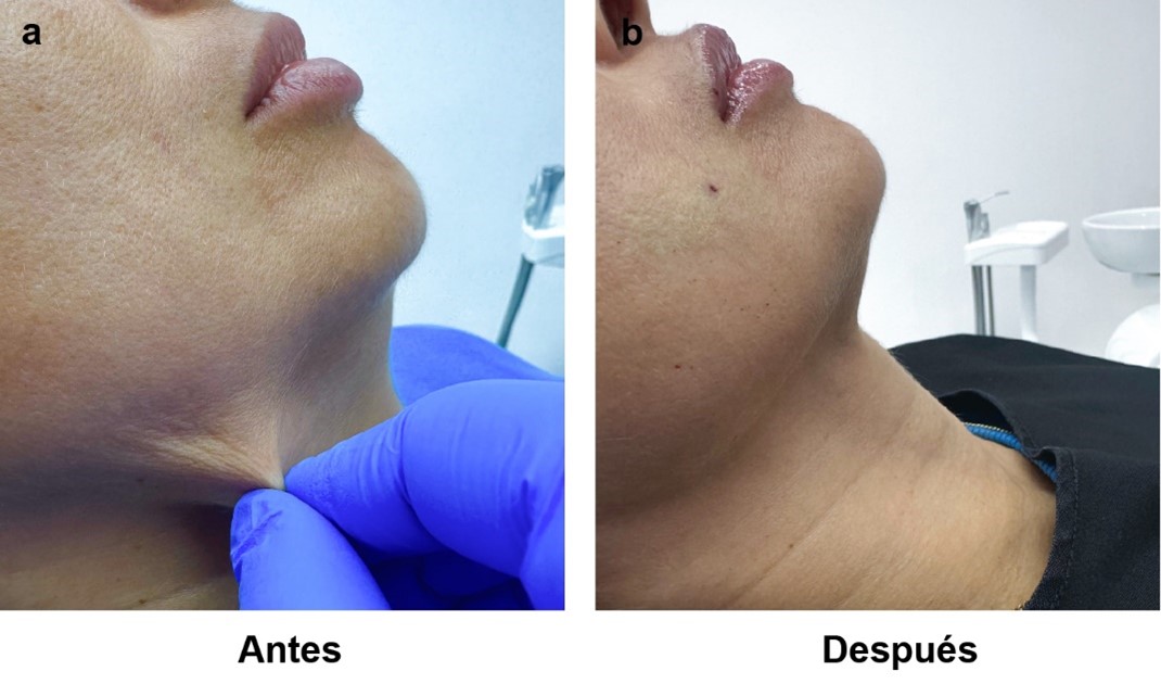 Diode Laser Assisted Facial Lifting: A New Technical and Case Report ...