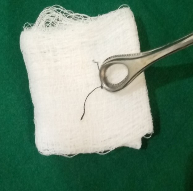 Partially Resorbed Unremoved Silk Sutures Three Years Post Perineal ...